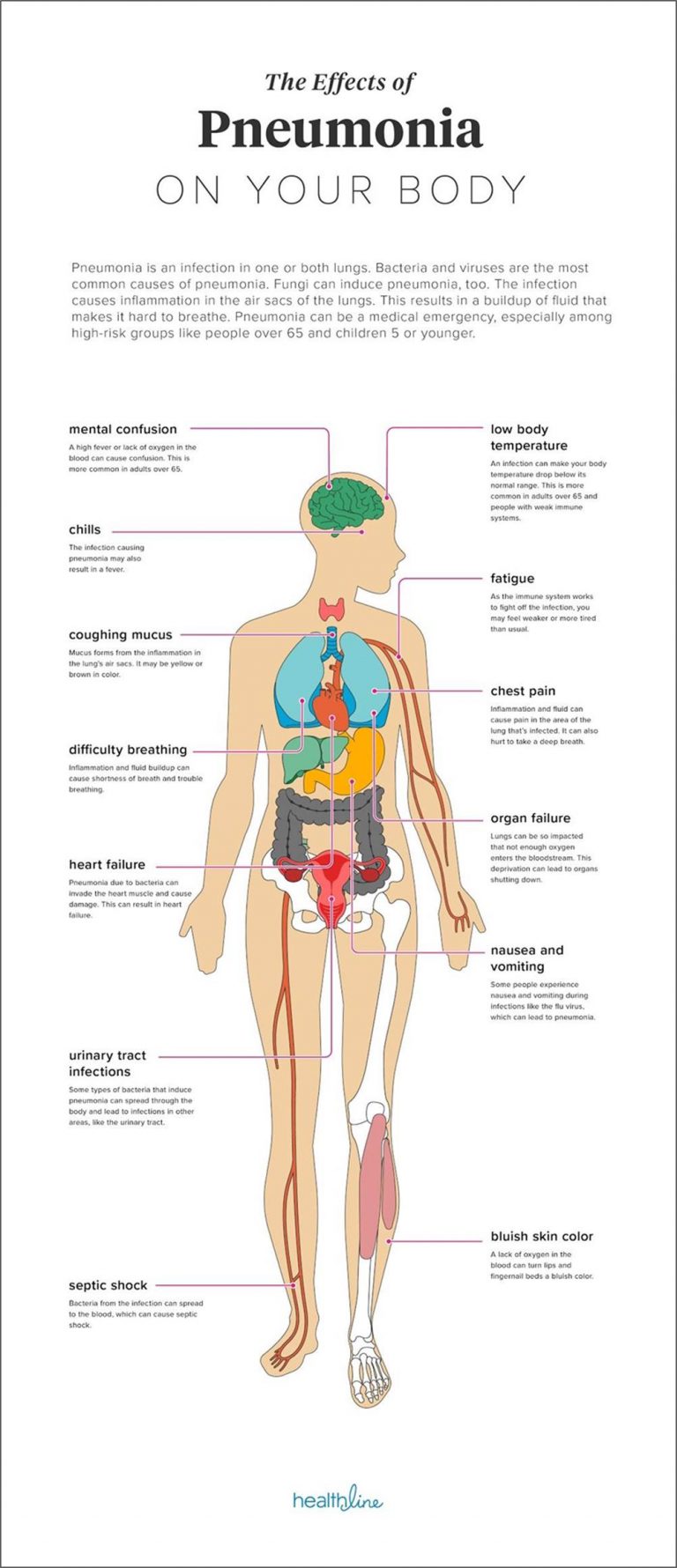 Pneumonia Prevention | Inspirational Stories